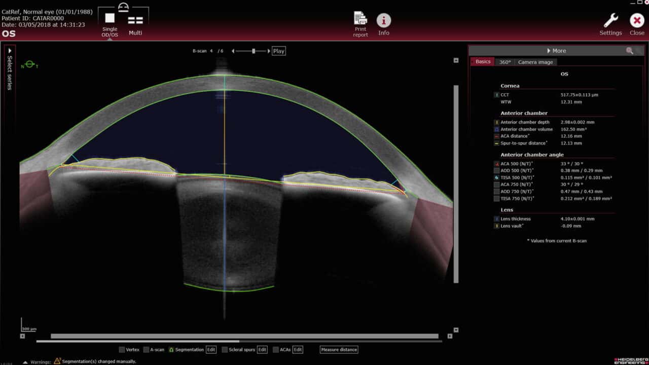 Anterion de Heidelberg Engineering | Arfamex equipos para dermatología ...