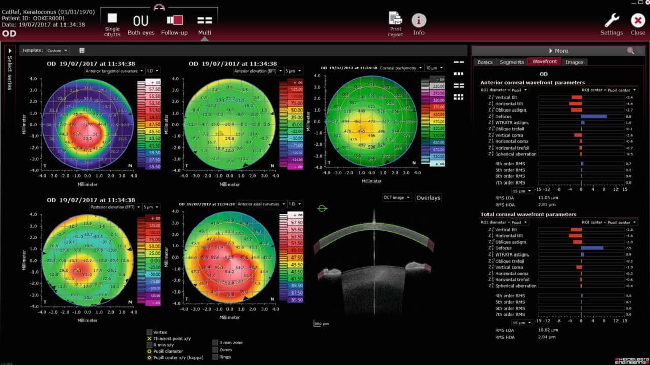 Anterion de Heidelberg Engineering | Arfamex equipos para dermatología ...
