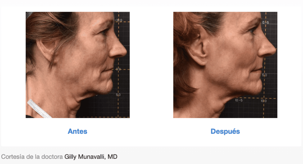 SOFWAVE - Arfamex equipos para dermatología y oftalmología